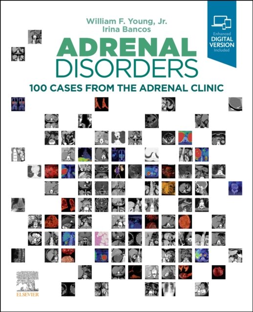 Adrenal Disorders | Irina, MD Bancos | Ark.no